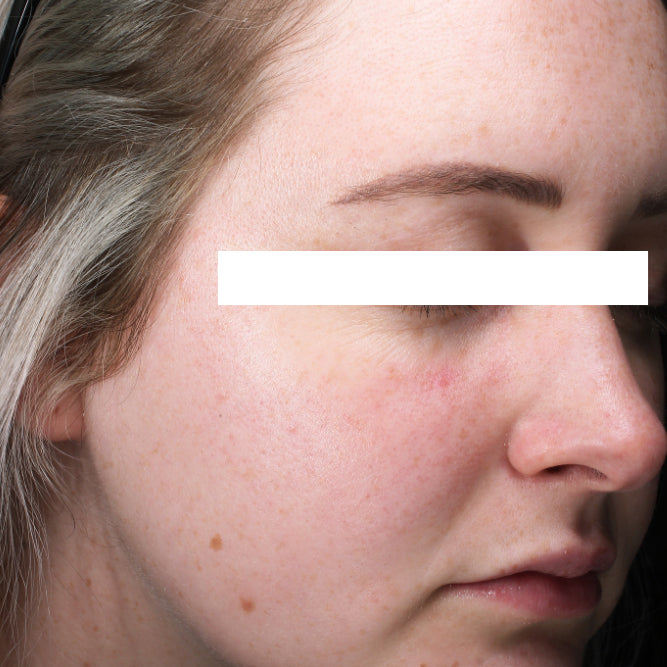 Cutera Excel V+ Laser Geelong – Vascular & Pigmentation Treatments ...